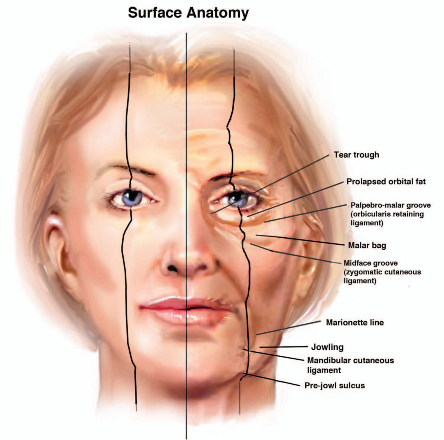 Facial Rejuvenation Surgery